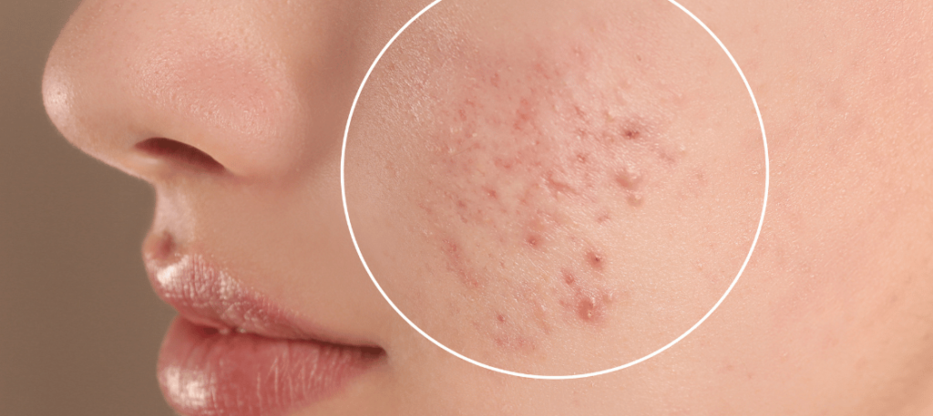 Acne 101: Understanding Types, Causes, and Effective Treatments